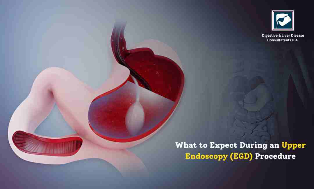 What to Expect During an Upper Endoscopy (EGD) Procedure
